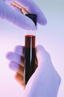 Alzheimer früh erkennen | PZ – Pharmazeutische Zeitung