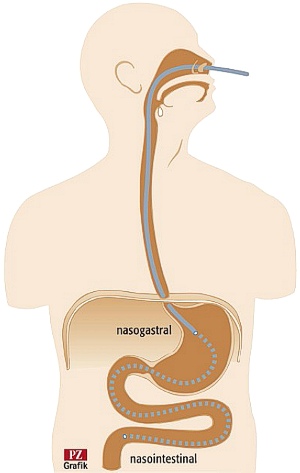 Pharmazeutische Zeitung online: Arzneimittelgabe: Was bei Sonden zu ...